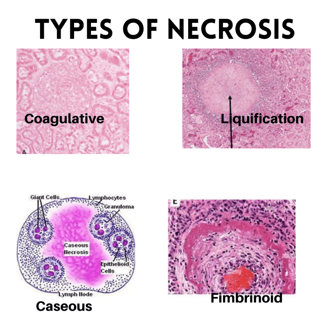 Necrosis: Pathology, Types & Causes- Healthpathy